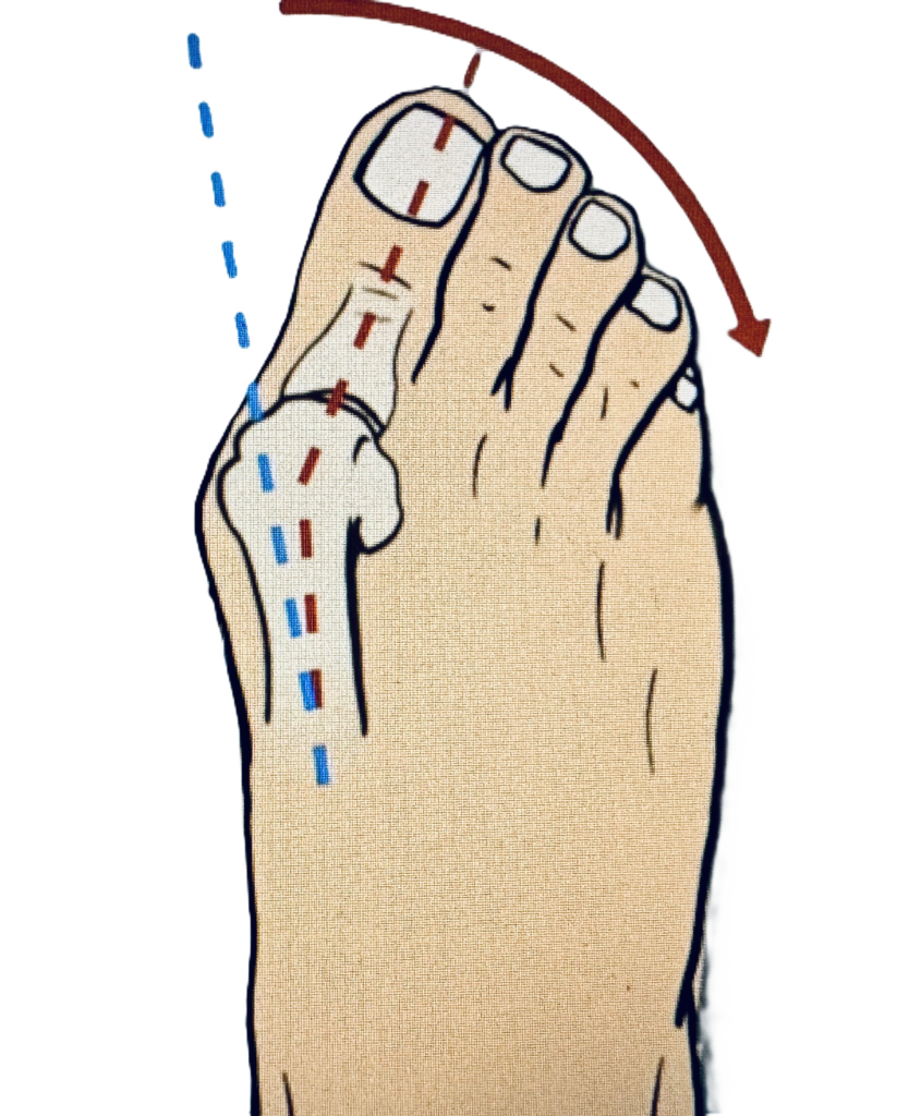 Hallux Valgus behandeling & advies | Sengers Podotherapie