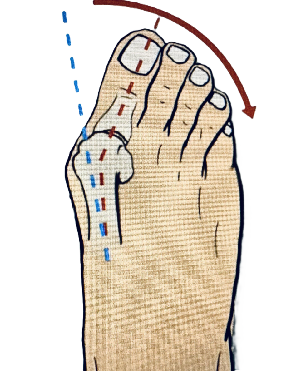 Knobbels onder de voet – behandeling | Sengers Podotherapie